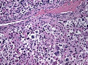 Astrocytoma Libre Pathology