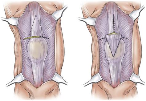 Quadriceps And Patellar Tendon Disruption Musculoskeletal Key