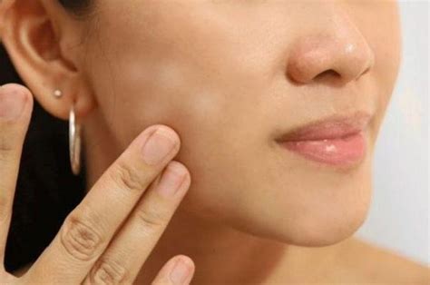 Pilihan Salep Panu Yang Tersedia Di Apotik Lengkap Dengan Harga Terbaru Grid Health