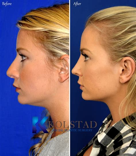 Nose Job San Diego At Linda France Blog