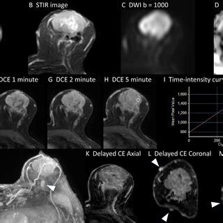An Oval Mass With Circumscribed Margin Is Hypo Intense On T1 Weighted