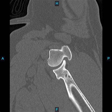 Koda Medial Coronoid Disease — Spryng™ With Osteocushion™ Technology