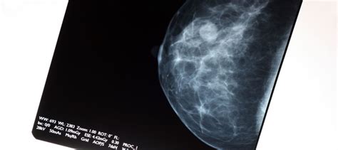 Abnormal Mammogram What Now Mediclinic