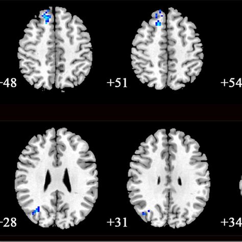 Spatial Patterns Of The Dmn Cen And Sn Admn Anterior Default Mode