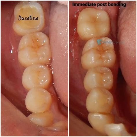 Orazen Dental Partial Coverage Restorations Are