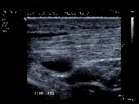 Hand Finger Pathology Ultrasoundpaedia