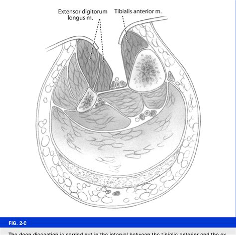 Figure From Vascularized Proximal Fibular Epiphyseal Transfer For Distal Radial Reconstruction