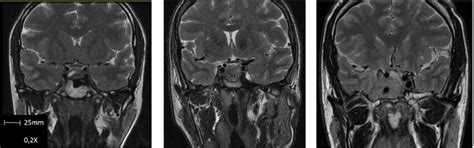 Examples Of Gh Pitnet T2 Weighted Mri Intensity Classification From Download Scientific