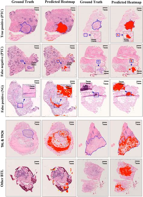 Frontiers Deep Learning Based Recognition Of Different Thyroid Cancer Categories Using Whole