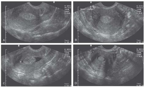 Leiomyomata Uteri And Myomectomy Obgyn Key