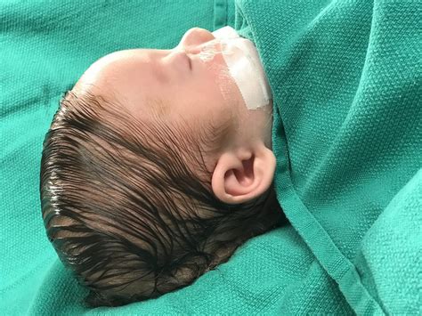 Metopic Synostosis Facts And Photos Craniosynostosis