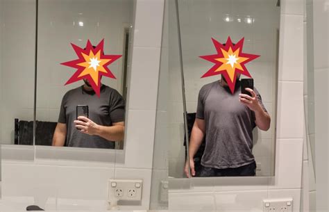 Same Shirt 4 Days Post Op R Gynecomastia