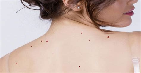 Em Seu Corpo Tem Bolinhas Vermelhas Como Essas Então Você Deve Ficar