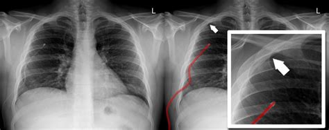 Chest Drain X Ray