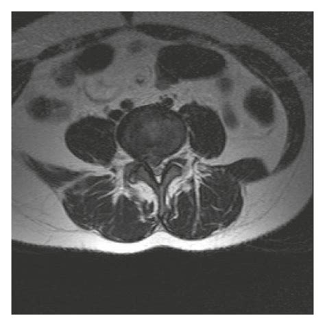 The Preoperative And Postoperative Imaging Data Of Patient Who Received
