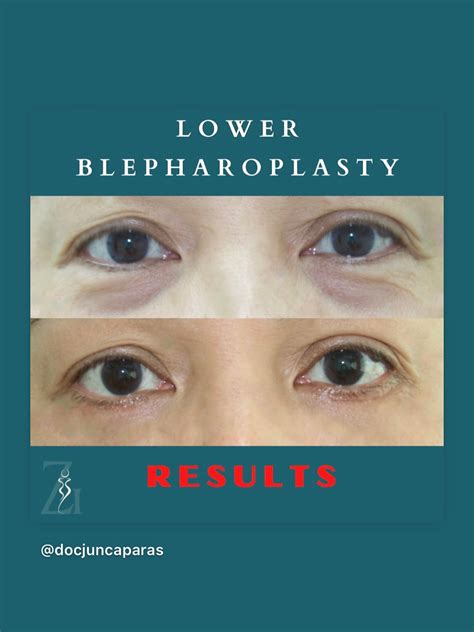 Dr Lutgardo Jun Caparas Jr Plastic And Reconstructive Surgeon Added