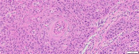 Human Tongue Squamous Cell Carcinoma Ffpe Sections