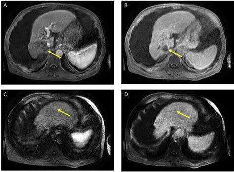 Figure 3 From Immunotherapy As A Neoadjuvant Therapy For A Patient With