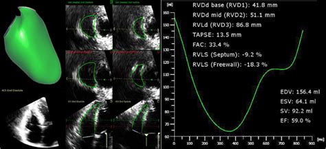 3d Right Ventricular Assessment Using Commercial Software For Right Download Scientific Diagram