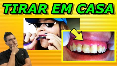 DÁ PRA TIRAR O APARELHO ORTODÔNTICO FIXO EM CASA O QUE ACONTECE OS DENTES YouTube
