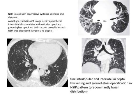 Connective Tissue Disease Associated Ild