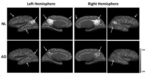 Comparison Of Resting State Connectivity Of The Dmn In Ad And Age Match Download Scientific