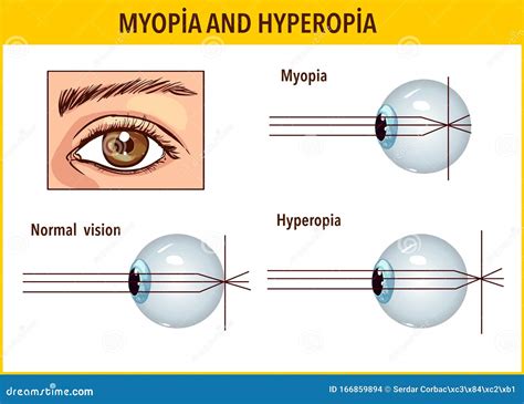 Visual Defects Myopia Hyperopia And Astigmatism Hoodoo Wallpaper