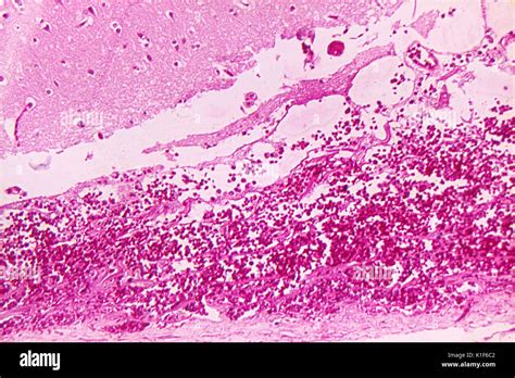 Viral Meningitis Histology