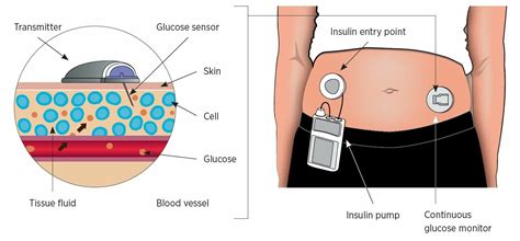 Continuous Subcutaneous Insulin Pump My Xxx Hot Girl