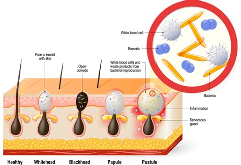 Acne Scar Treatment Singapore Acne Laser Treatment And Removal In Singapore