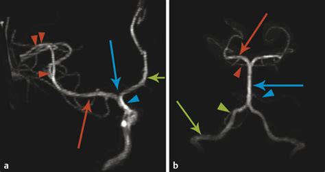 12 Vascular Abnormalities Radiology Key