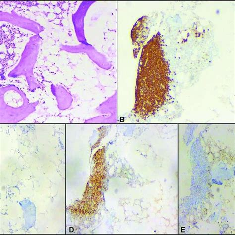 Benign Lymphoid Aggregates Showing Mixed Population Of B And T Cells Download Scientific