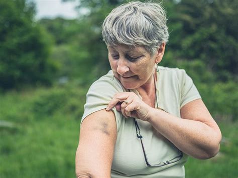 Bruise That Wont Go Away Causes Concerns Treatment And More