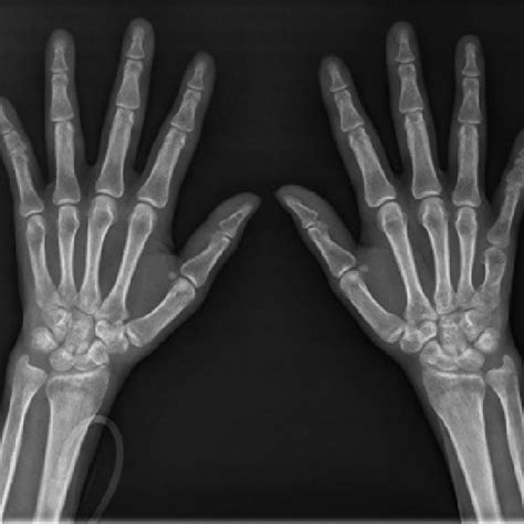 X Ray Image Showing Soft Tissue Swelling Of Multiple Joints Of Hands