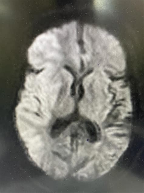 Dr Rajeshwar Sahonta On Linkedin A 72 Year Old Man Presented With