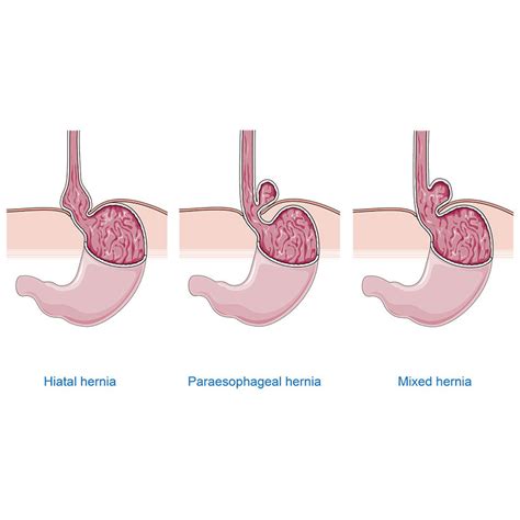 Hernia Vector Illustration