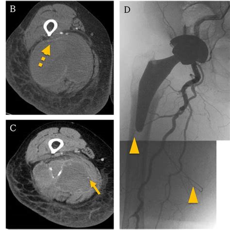 Arterial Supply To The Left Lower Extremity A Sciatic Artery Forming Download Scientific
