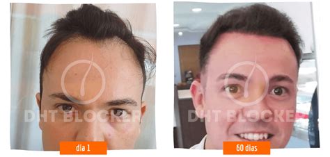 Dht Blocker Oferta Exclusiva Site Oficial
