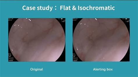 Real Time Polyp Detection Ai For Flat And Isochromatic Cases Youtube
