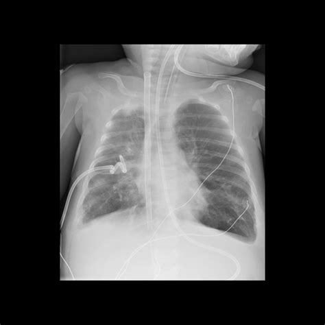 Ecmo Katheterspitze Pacs