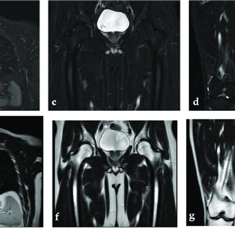 Heterotopic Ossification Brooker´s Classification N 1522 Download
