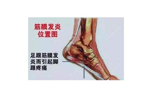 足底筋膜炎怎么治好 知乎