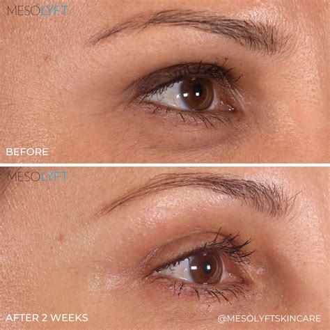 Mesolyft Eyes Hydrate Dry Skin Vegan Beauty Derma Roller