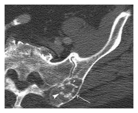 Chondrosarcoma A 62 Year Old Male Presents With Right Hip Pain