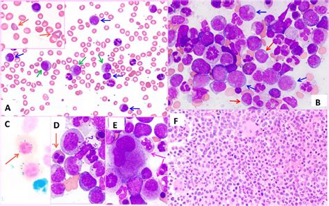 Ringed Sideroblasts Vs Basophilic Stippling