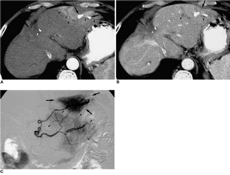Arterioportal Shunt Secondary To Transarterial Chemoembolization A Ct Download Scientific