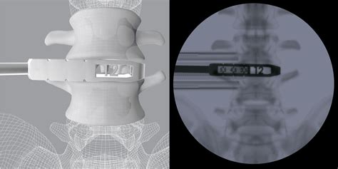 Corelink Releases First Of Its Kind Oblique Lumbar Interbody Fusion