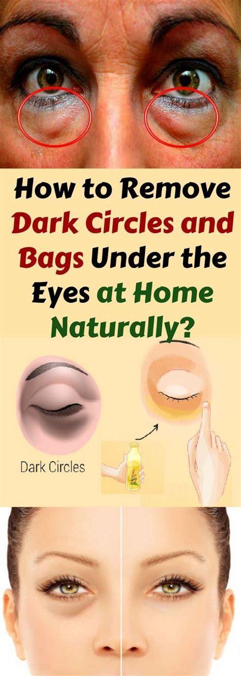 How To Remove Dark Circles Bags Under The Eyes At Home Naturally HEALTH