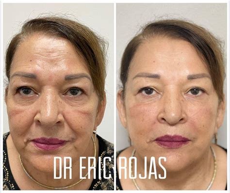 Rejuvenece tu rostro con la mejor técnica Dr Eric Rojas Dermatología Laser Center