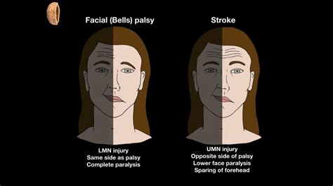【神经系统解剖学】面瘫与中风 中枢性面瘫 周围性面瘫 大脑皮质 面神经核 上、下运动神经元 医学双语 红a大法好啊 学习 哔哩哔哩视频
